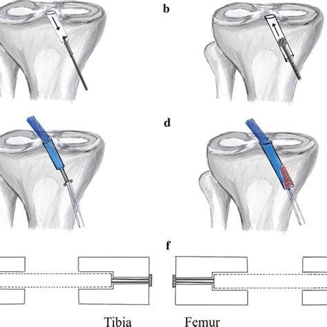 Illustration Of Tibial Tunnel Preparation By Retrograde Tunnel Drilling