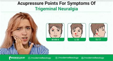 Trigeminal Neuralgia Trigger Points
