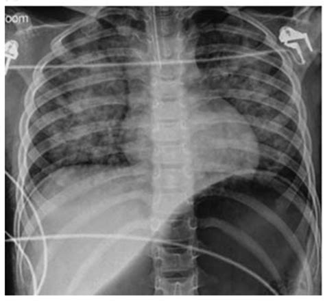 Pediatric Drowning Em Sim Cases