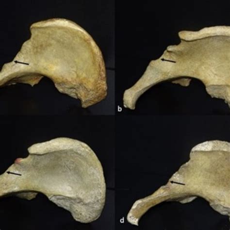 The View Of The Morphology Of The Anterior Acetabular Ridge A