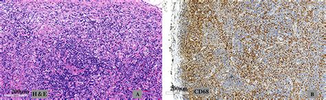 A Cervical Lymph Node Biopsy Section Areas Of Lymphocytic Download Scientific Diagram