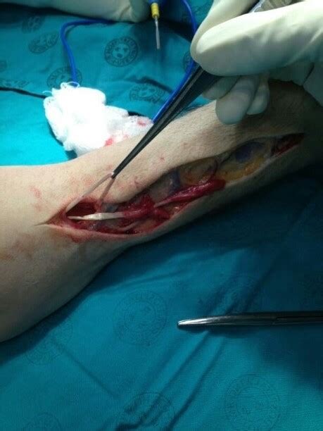 Closed Traumatic Avulsion Of Extensor Digitorium Communis And Extensor