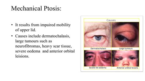 Anatomy Of Eyelid And Ptosis Pptx