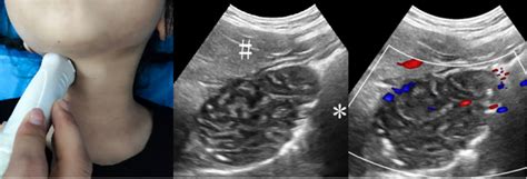 Ultrasonic Image Characteristics Of Palatine Tonsils In Healthy