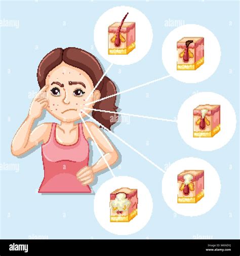 Scientific Medical Illustration Of Pimple Formation Illustration Stock Vector Image Art Alamy