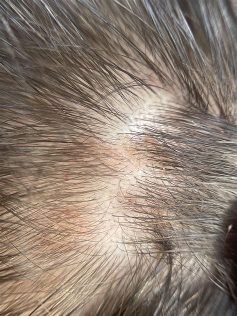 3yrs With Seb Derm Photos R Sebderm