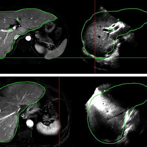 Pdf A Model Based Registration Approach Of Preoperative Mri With 3d