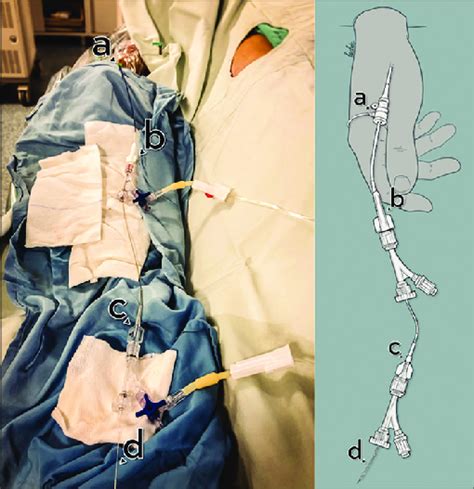 A Sheath Penetrating Radial Artery Through Snuffbox B Guide