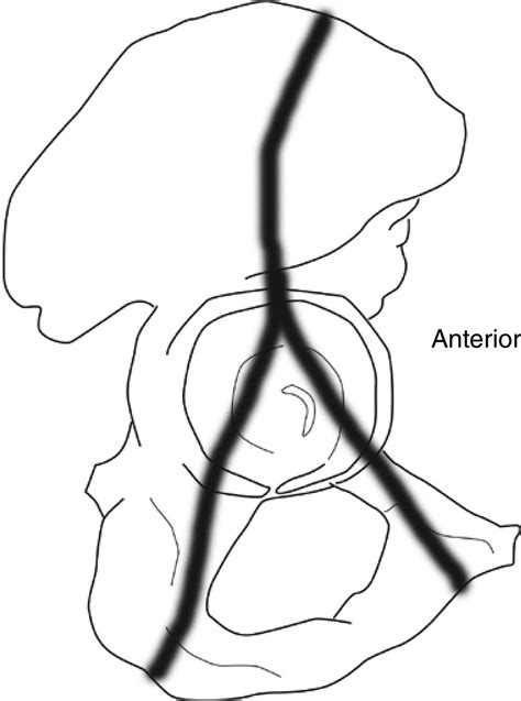 The Spur Sign Radiology