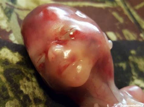 عکس جنین سقط شده سه ماهه پسر