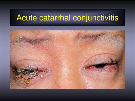 Ppt 结 膜 疾 病 Disease Of The Conjunctiva Powerpoint Presentation Id 9650002