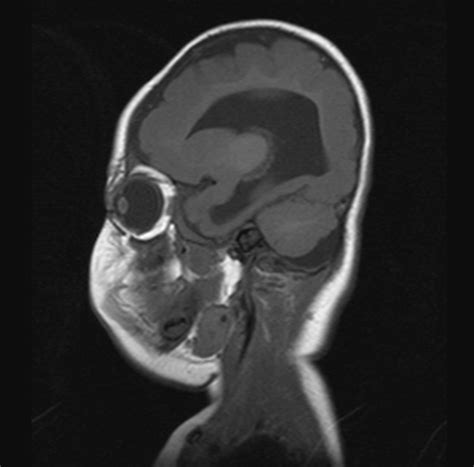 Global Developmental Delay Neuropediology
