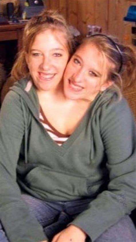 Conjoined Twins Abby Hensel From Abby And Brittany Are Now Married