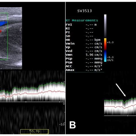 Surgical Procedures Of Open Splenectomy A Initial Skin Incision Was