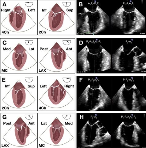 Guidelines For Performing A Comprehensive Transesophageal Echocardiographic Examination
