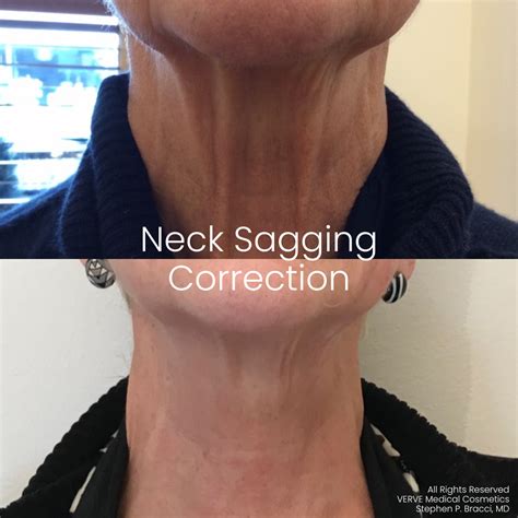 Neck Sagging Correction Treatment Cosmetic Fillers Nose Contouring