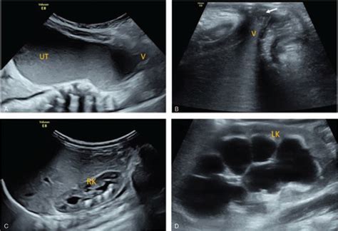 A Case Report Of Hydronephrosis Caused By Imperforate Hymen In An