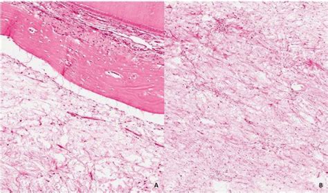 Odontogenic Myxomas What Is The Ideal Treatment Bmj Case Reports
