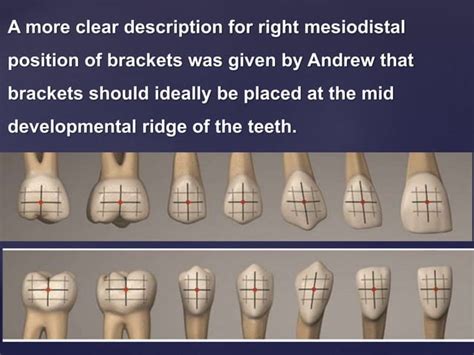 Placement Of Orthodontic Brackets Ppt