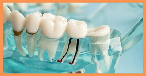 The Benefits Of A Root Canal Why Its Better Than Tooth Extraction Dr Khullar Clinic