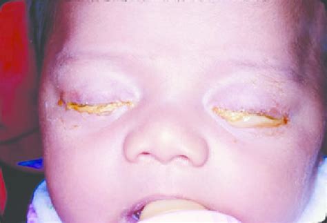Gonorrhea In Babies Eyes