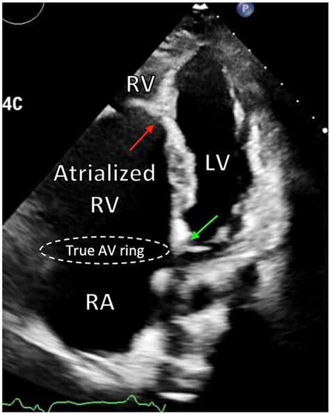 The Utility Of Multimodality Imaging In A Patient With Ebstein Anomaly