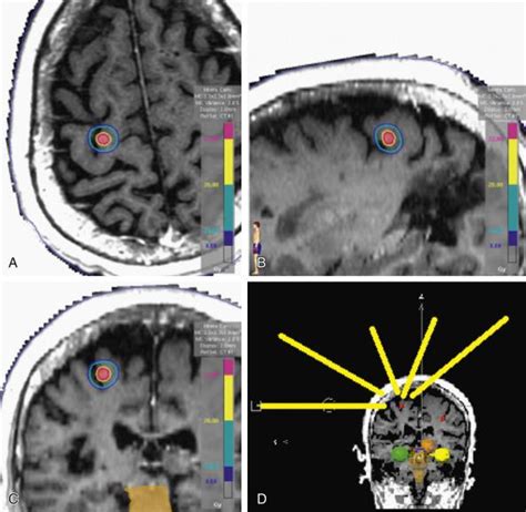 Stereotactic Irradiation Cns Tumors Clinical Tree