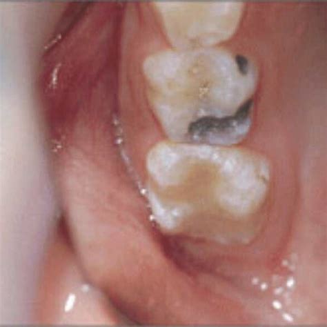 Moderate Fluorosis Fig 6 Moderate Fluorosis Download Scientific