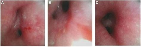 Bronchoscopic Findings A Shows That The Left Upper Bronchus Was