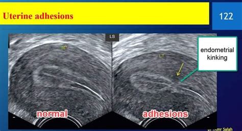 Ashermans Syndrome Uterine Ultrasound Guided Tips Facebook