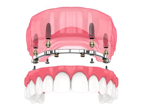 Are Upper Denture Implants Better Than Traditional Dentures