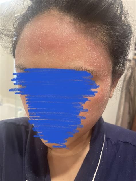 Personal Experience Of Seb Derm Rsebderm