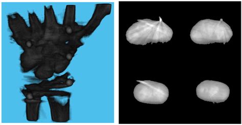 3d Reconstruction Of Wrist Bones From C Arm Fluoroscopy Using Planar