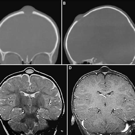 Pdf Subgaleal Dermoid Tumors At The Anterior Fontanelle