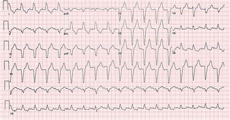 Sinus Rhythm With Lbbb Album On Imgur