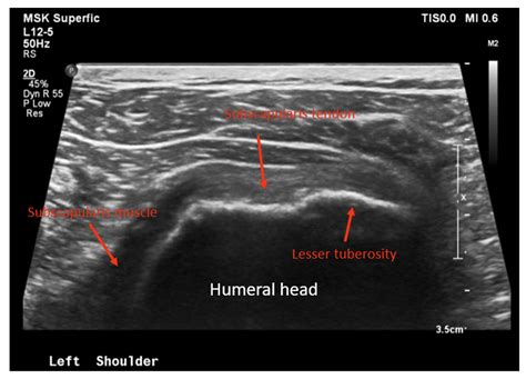 Biologic Augmentation Of The Subscapularis Tendon During Anatomic