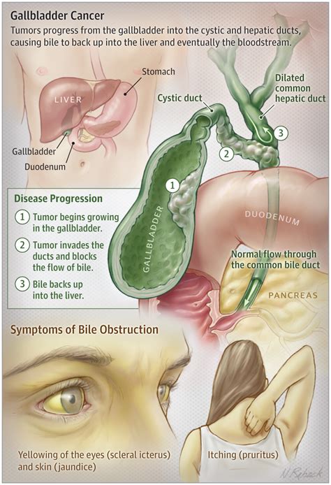 Diagram Bismuth Corlette Classification Of Perihilar Cholangiocarcinoma Artofit