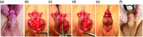 Photographs Of The Modified TIP Surgical Procedure A Preoperative Download Scientific Diagram