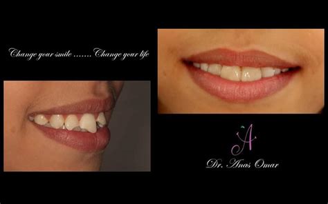 Multiple Crowns Fractures Omar Anas Prosthocontest2019