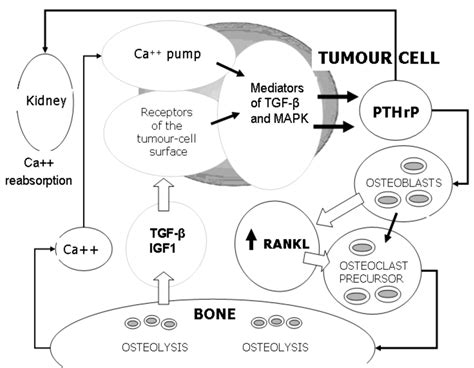 Cancer Induced Hypercalcemia Anticancer Research
