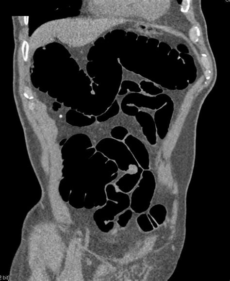 Polyp In Tortuous Descending Colon Which Is On A Stalk Colon