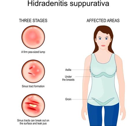Hidradenitis Suppurativa Causes Symptoms And Treatment
