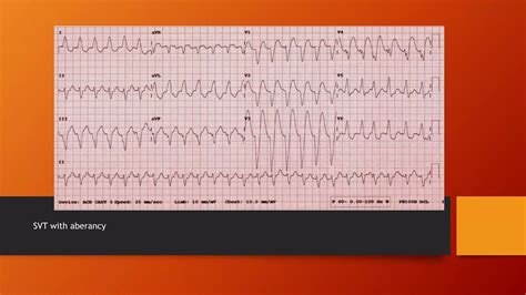 1 Rhythm Recognition Pptx
