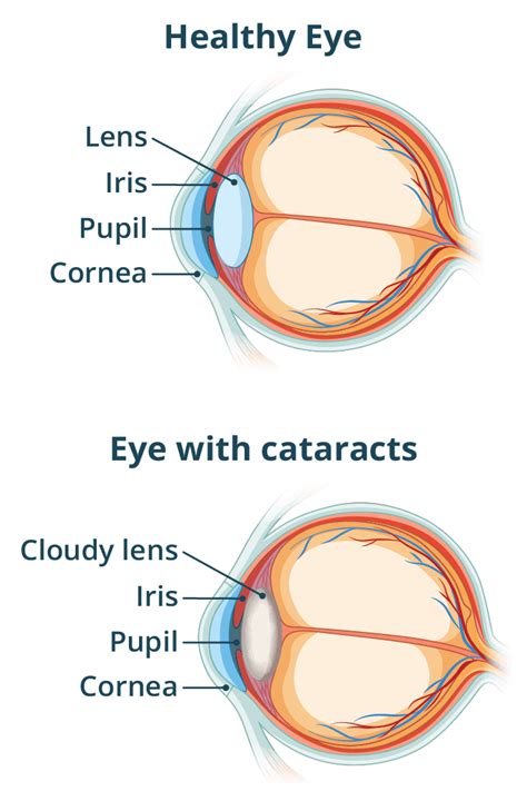 Coronary Cataract