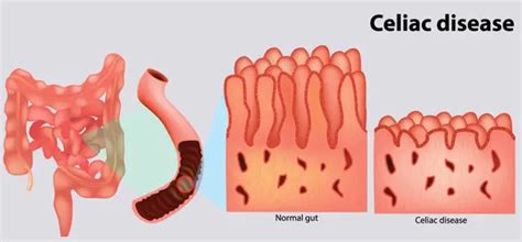 Celiac Disease Treatment