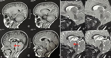 Pallister Hall Syndrome A 3 Year Old Girl With Short Stature And