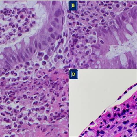 A Crypt Abscess Hematoxylin Eosin Dye Magnification X 40 B