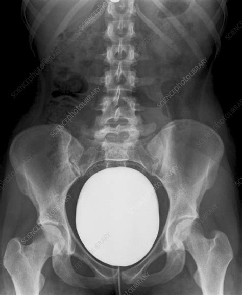 Urinary Bladder Examination X Ray Stock Image C0337255 Science Photo Library