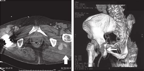Enhanced Computed Tomography Scan Shows An Aneurysm Of The Persistent Download Scientific