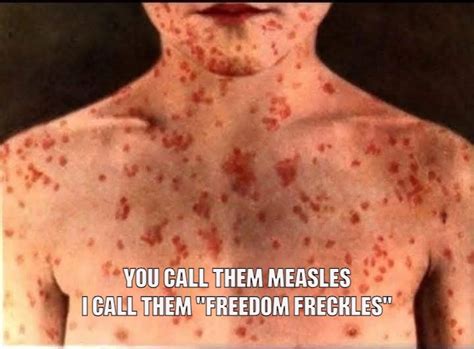 Freedom Freckles Thanks To Those That Thought Of A Better Title Album On Imgur